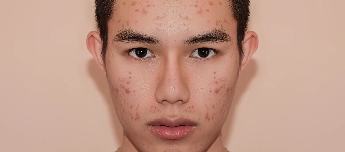 How To Fade Post-Inflammatory Hyperpigmentation: Top Tips And ...